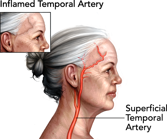 What is Giant Cell Arteritis? | ACTEMRA® (tocilizumab)
